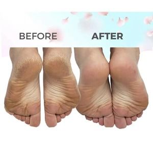 Cacee | Bath & Body | Callus Remover Foot Tea Tree Oil Lemon Feet Gel ...